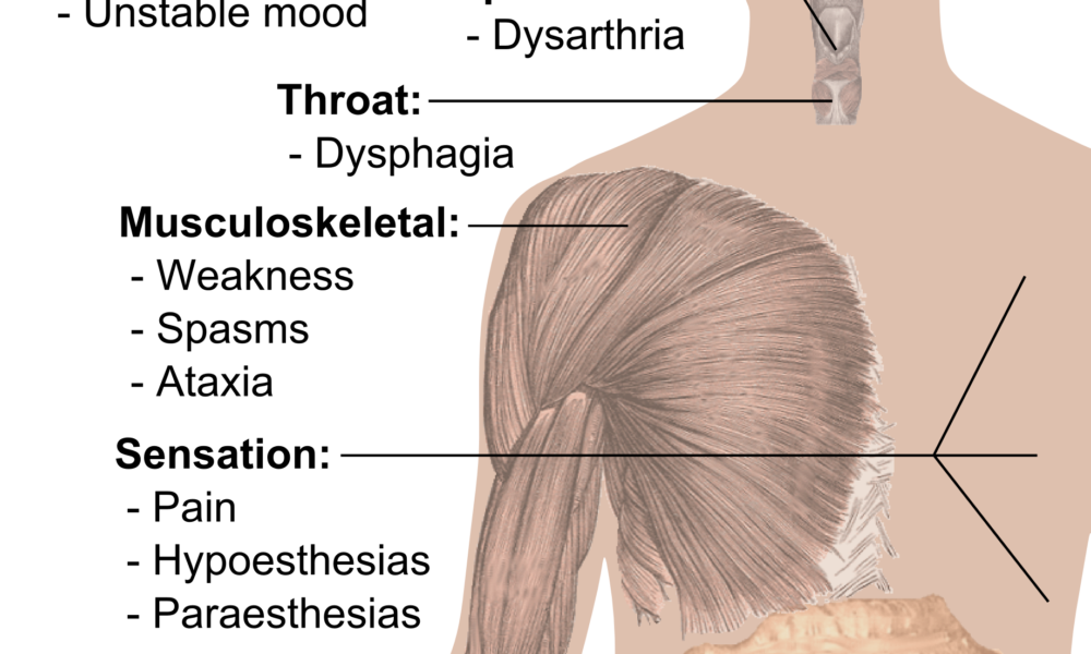 What are visible signs of MS? - TechDIY.info